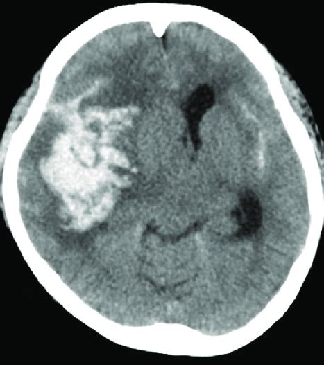 Head Computed Tomography Scan At The Onset Of Subarachnoid Hemorrhage