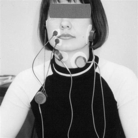Locations Of Electromyogram Electrodes For Testing Orbicularis Oris