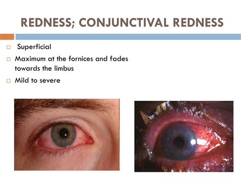 Ppt Diseases Of The Conjunctiva Ayesha S Abdullah 21092013