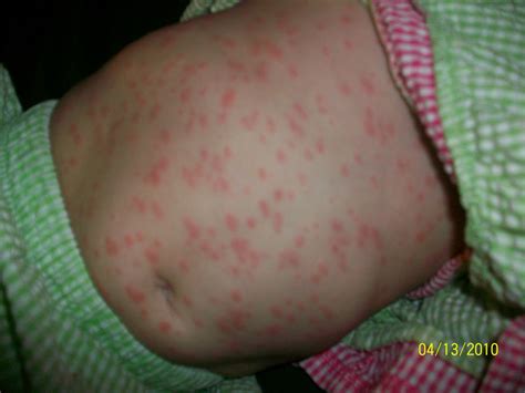 Fast Chicken Pox Cure Stefan Hall