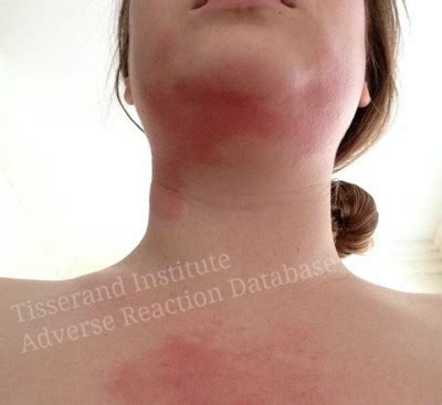 Irritation And Allergic Reactions Tisserand Institute