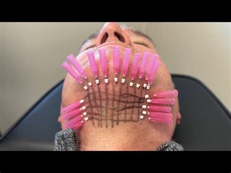Smooth Threads For A Strong Jawline Male Under Chin Treatment YouTube