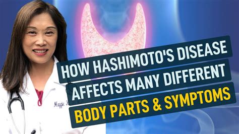 How Hashimotos Disease Affects Many Body Parts And Symptoms Maggie Yu