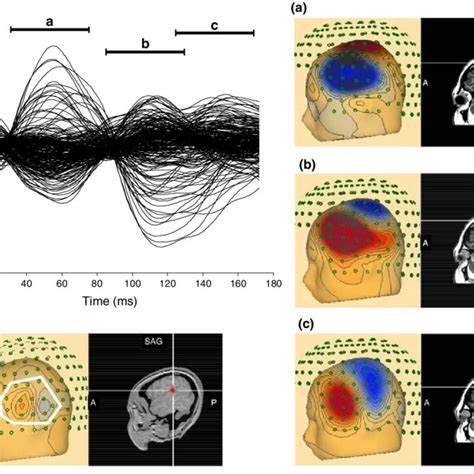 Dipole Source Localization Three Ecds Are Shown Based On A Single Download Scientific Diagram