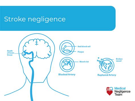 Stroke Negligence Medical Negligence Team