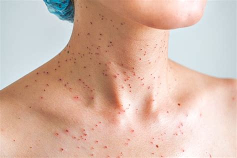 Red Spots On Skin Red Spots On Skin Causes And Best Ways To Sure Them