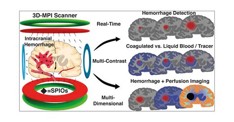 Intracerebral Hemorrhage Vs Subarachnoid Hemorrhage