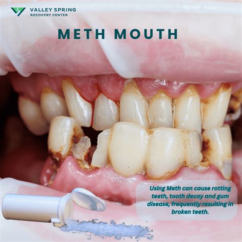Methamphetamine Addiction Symptoms Causes Effects And Treatment