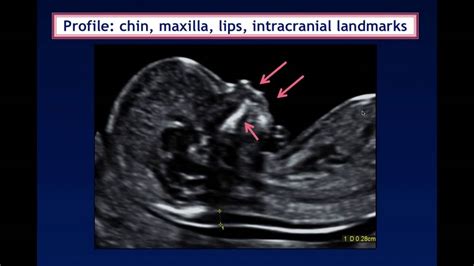 Cleft Lip 15 Week Ultrasound