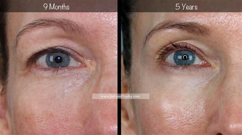 5 Year Retin A Results ~ Before And After For Wrinkles And Anti Aging