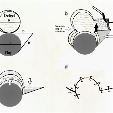 “flap To Defect” Concept For Closure Of Circular Skin Defects The Ice Cream Cone Flap