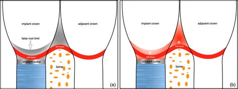 Schematic Drawings Indicating A Interproximal Space And Collar