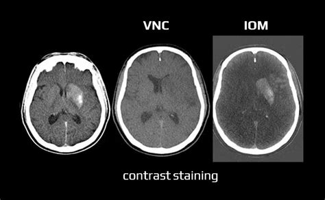 Dual Energy Ct In Differentiating Hemorrhage Vs Contrast Staining