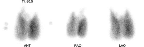 99m Technetium Pertechnetate Scintigraphy Scan Showing An Enlarged Download Scientific Diagram