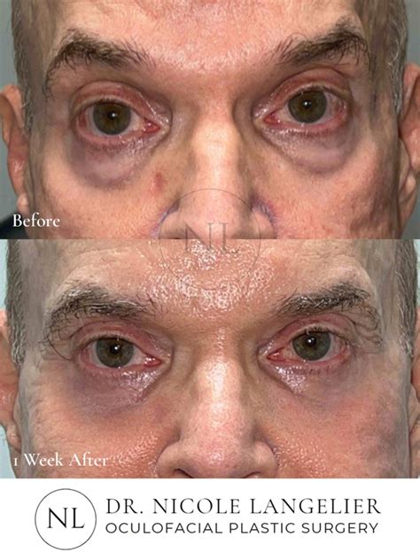 Male Lower Eyelid Blepharoplasty Dr Langelier