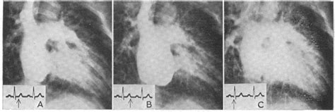 Figure 5 From Rapid Biplane Angiocardiography In Thle Tetralogy Of