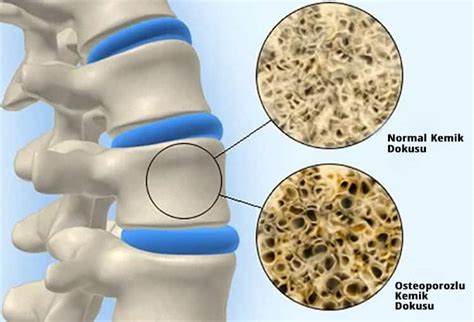 Kemik Erimesi Osteoporoz Tedavisi İçin Dr Ümit Aktaş tan Bitkisel Kürler