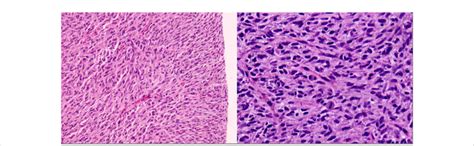 Pathology Microscopic Examination Shows Spindle Shaped Tumor Cells
