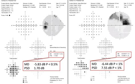 10 2 Field Testing Best Predictor Of Glaucoma Progression