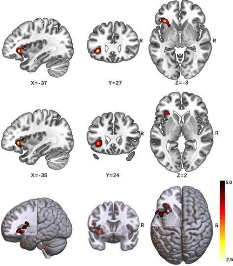 The Brain Region With The Significant Increased Rsfc Between Roi 2 And