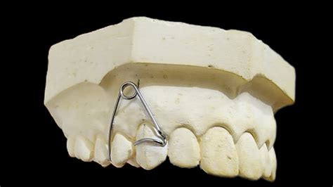 Orthodontic Wire Bending At Catherine Dorsey Blog