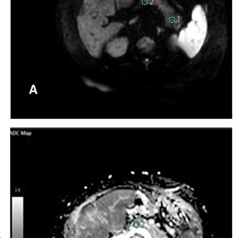 A B On Dw Mri Diffuse Restriction Througout The Pancreas A And On Download Scientific