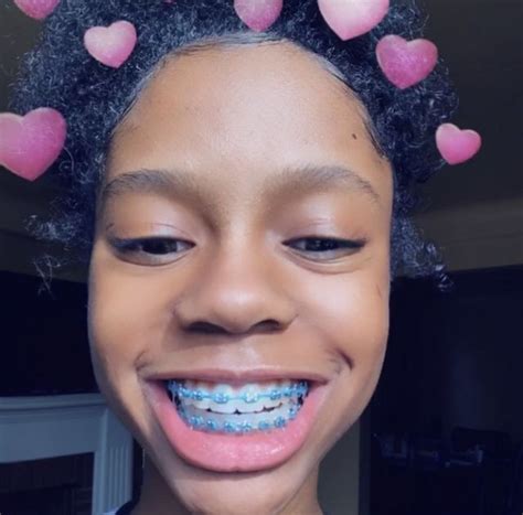 Pin On Badies Braces Colors Braces Tips Cute Braces