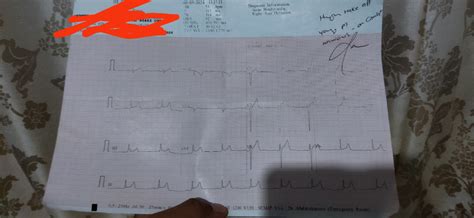 Right Axis Deviation R Readmyecg
