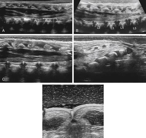 Neonatalinfant Spine Sonographic Tendencies