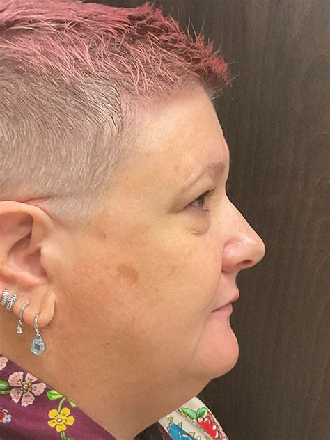 Patient 131839196 Ipl Before And After Photos Highwater Aesthetics