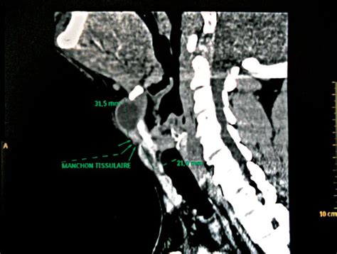 Cervical Cyst Definition And Management Lombafit