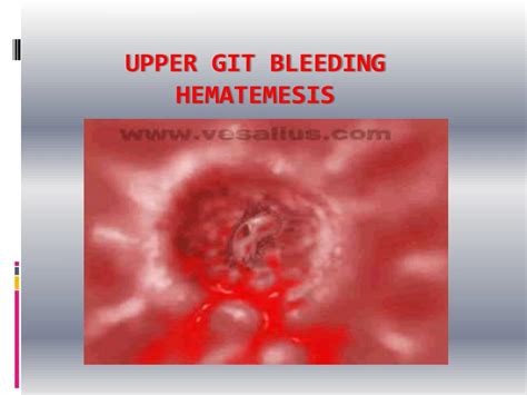 Ppt Upper Git Bleeding Hematemesis Powerpoint Presentation Free