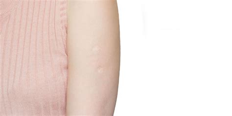 La Vacuna Que Dejaba Marca En El Brazo Se Sigue Poniendo