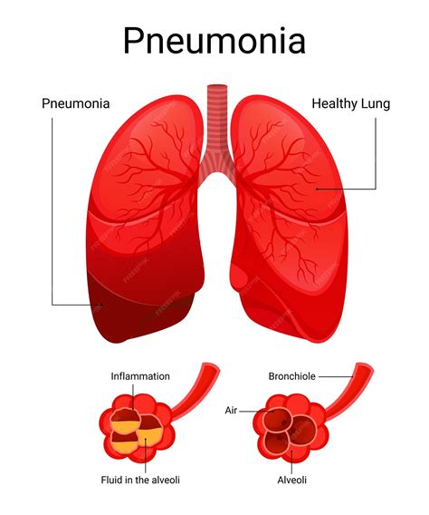 Diagrama De La Neumonía Y Los Pulmones Sanos Vector Premium
