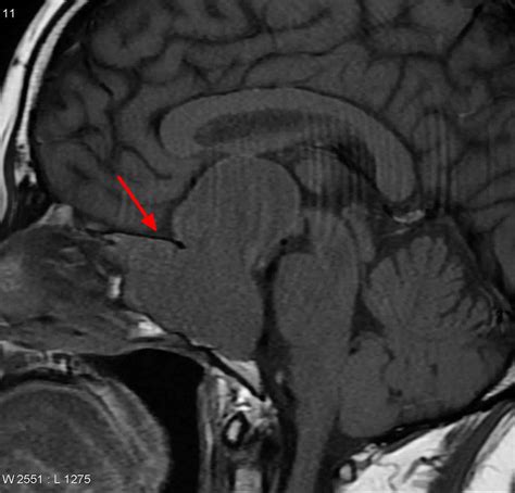 Pituitary Adenoma Causes Symptoms Diagnosis Treatment And Prognosis
