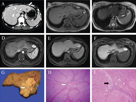 Focal Nodular Hyperplasia Gross