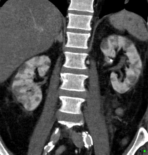 Spotted Nephrograms Severe Hypotension Image