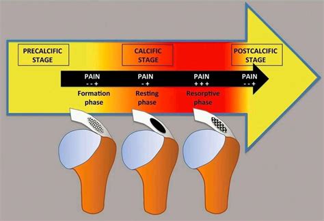 Shoulder Rc Tendon Pathology And Conservative Treatment Stay Tuned For