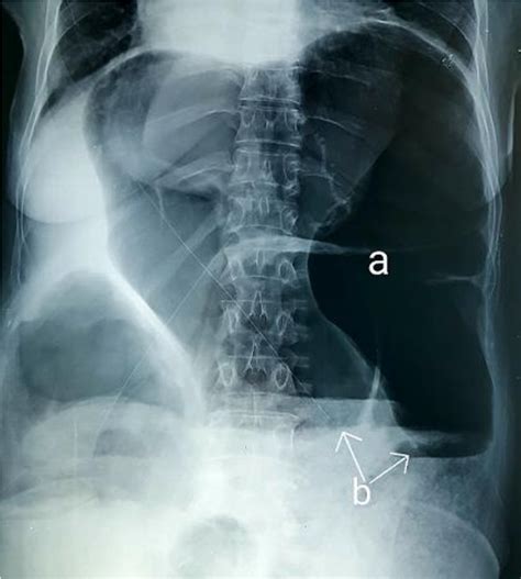 Figure 1 From Synchronous Volvulus Of The Transverse And Sigmoid Colon