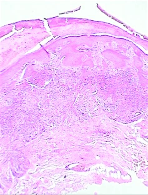 Section On 20× Magnification Showing Dense Lymphocytic Infiltrate