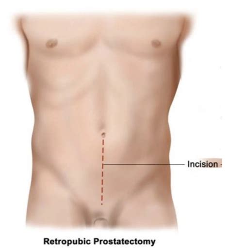 Prostatectomy Open Radical — Urology Care Toowoomba Dr Nikhil Sapre