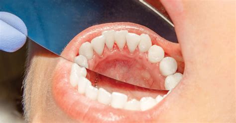 Oral Cancer Symptoms Subtle Signs That Can Indicate Cancerous Growth