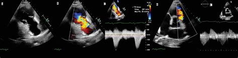 Figure 1 From Carcinoid Heart Disease A Review Of Pathophysiology
