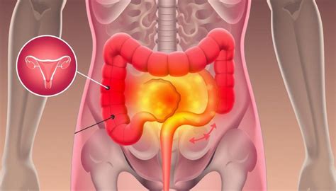 Endometriosis And Appendicitis Link Explained
