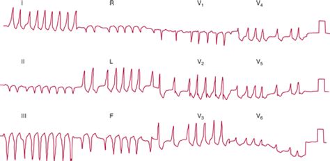 Atrial Fibrillation Thoracic Key