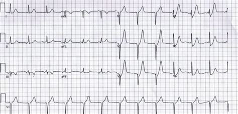 De Winter T Wave • Litfl • Ecg Library Diagnosis