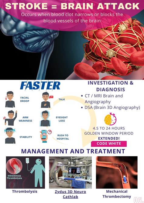 Stroke Symptoms And Treatment Center In Ahmedabad Udaipur Bhilwara