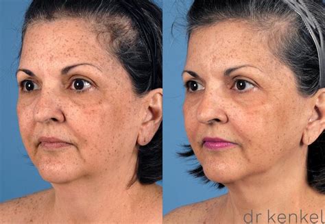 Neck Lift Case 260