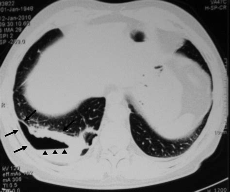 Pseudochylothorax In A Patient With Rheumatoid Arthritis The Journal