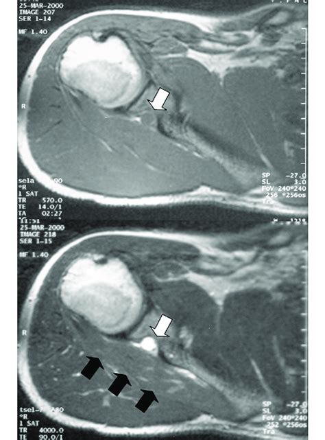 Compression Neuropathy Of Suprascapular Nerve A Ganglion White Arrow Download Scientific